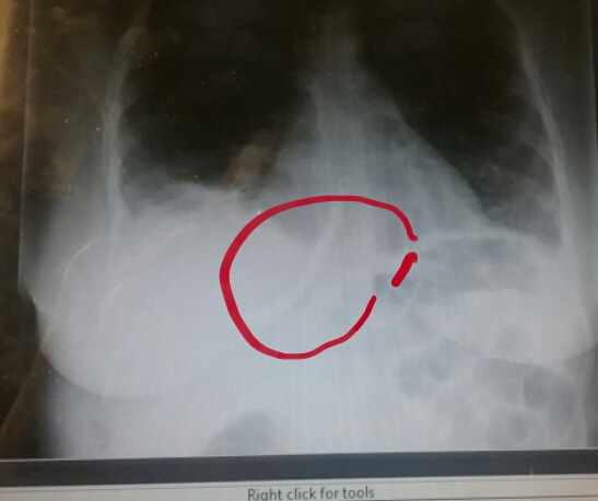 Titanium Rib Plating Photos Of My Surgery Video