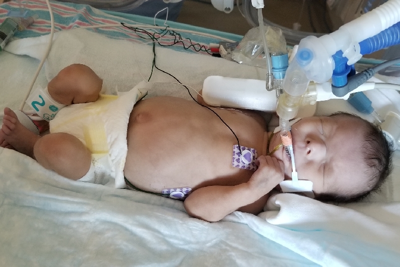 Fundraiser By Summer Anaya Alice Has Neonatal Marfan Syndrome